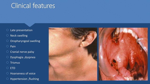 Parapharyngeal Space Tumors