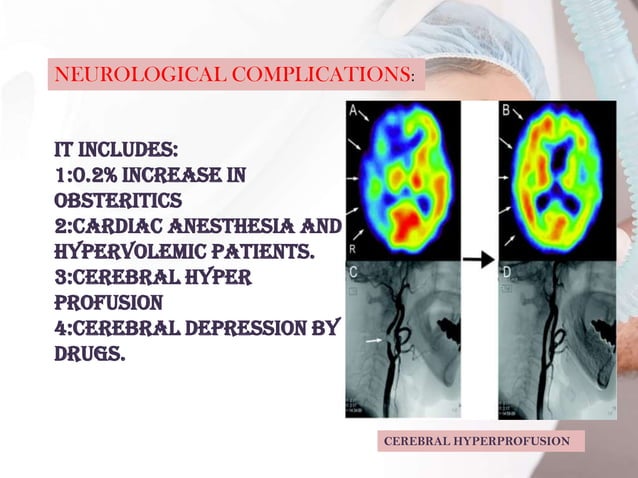 GENERAL ANESTHESIA AND ITS COMPLICATIONS | PPTX