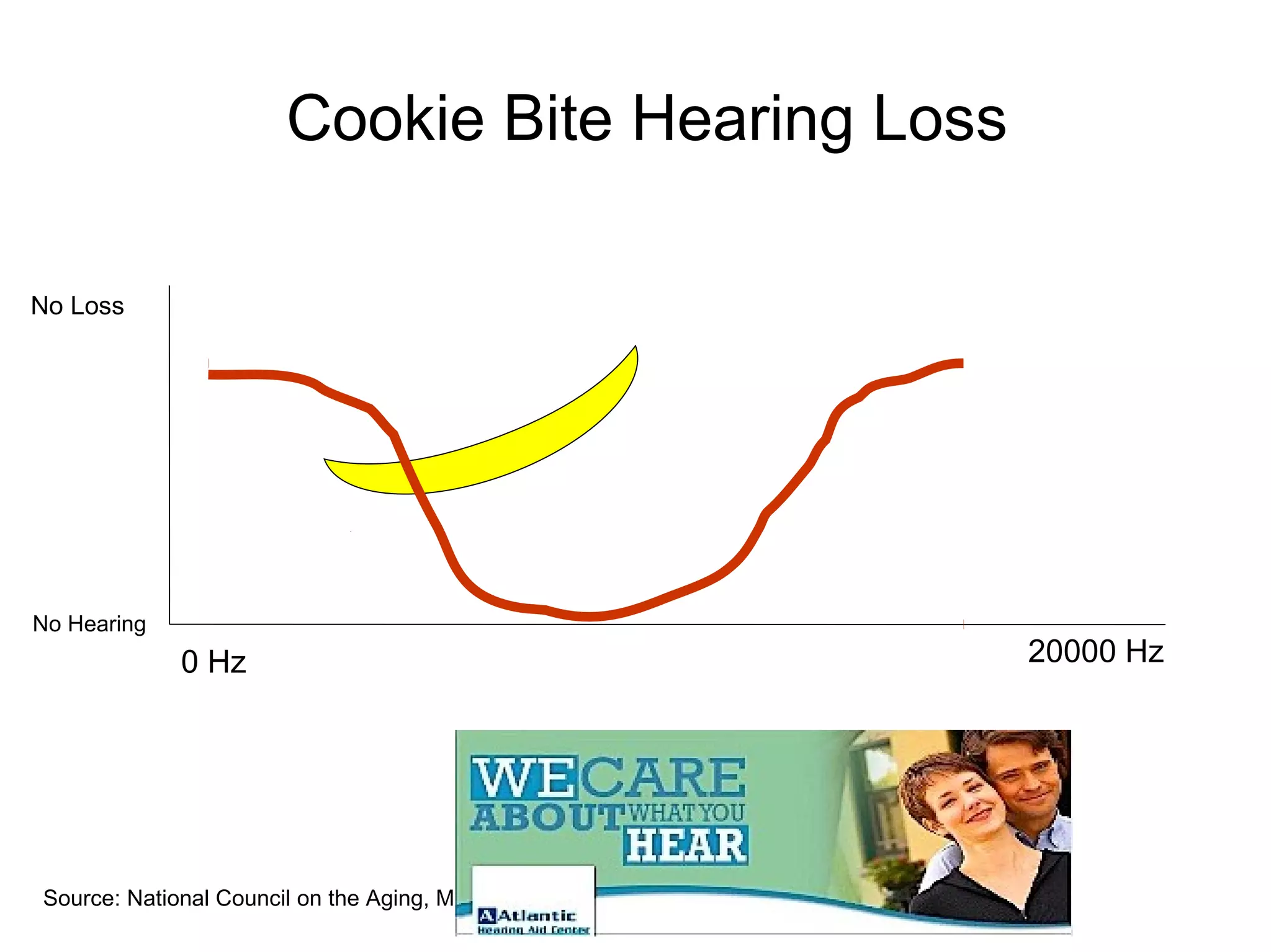 Cookie Bite Hearing Loss | PPT