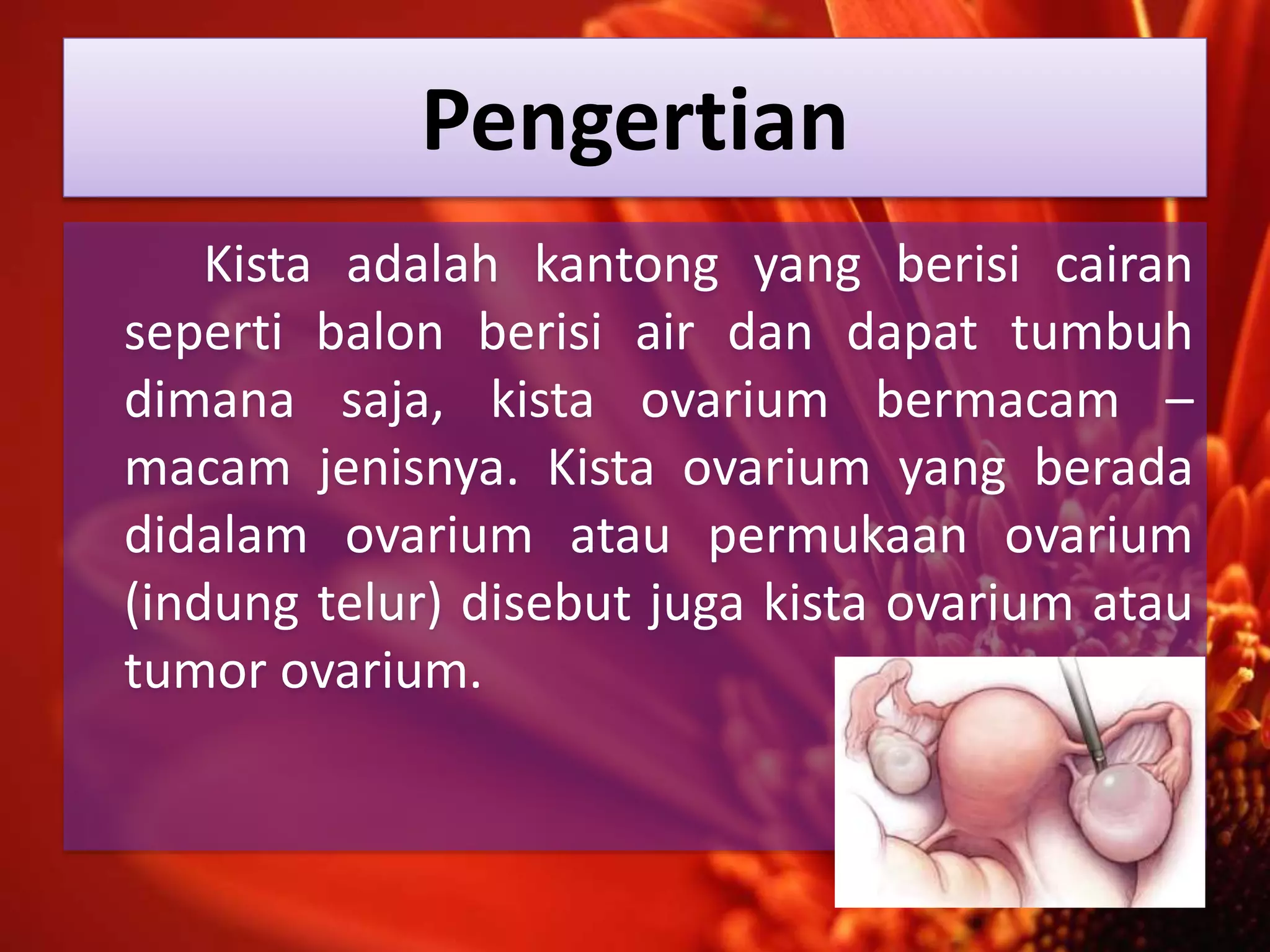 Kista Ovarium | PPTX