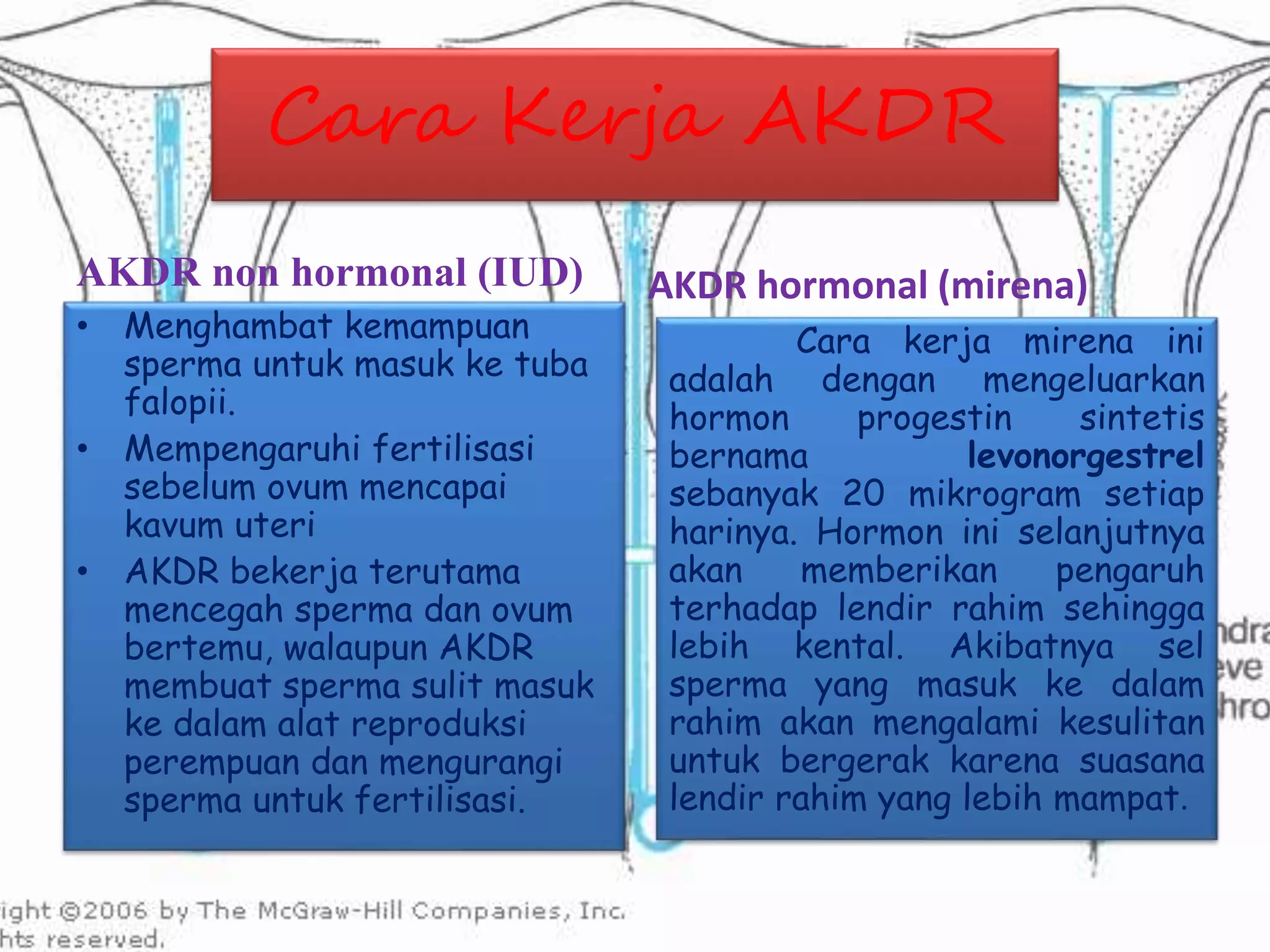 Kontrasepsi IUD | PPTX