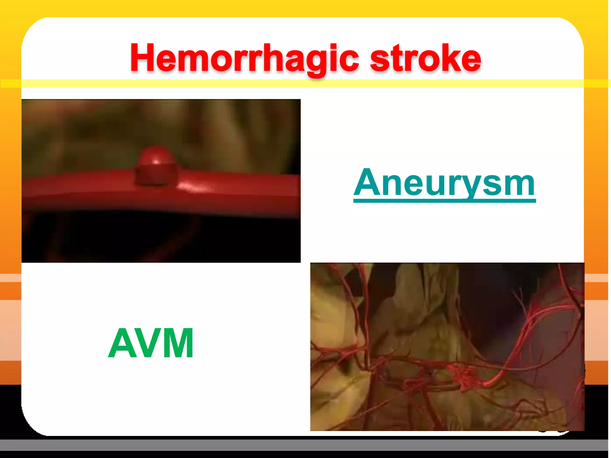 Ppt. stroke1 | PPTX