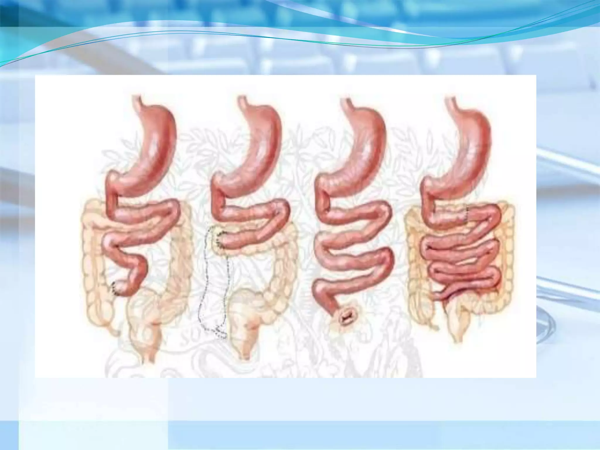 SHORT BOWEL SYNDROME_CASE STUDY | PPTX