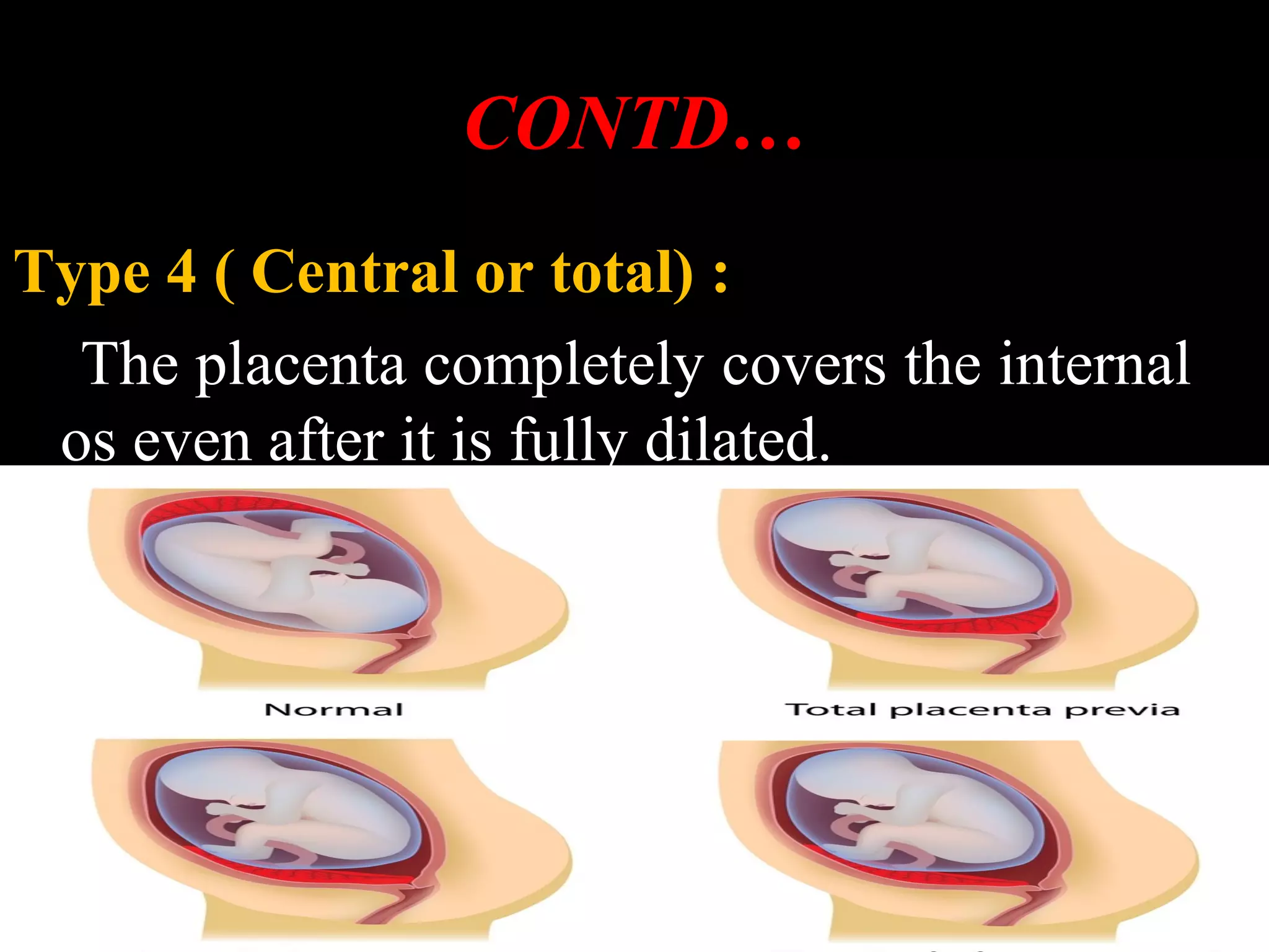 Placenta previa | PPT