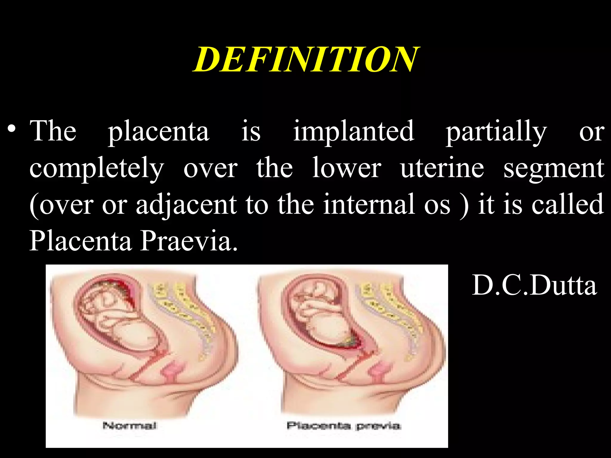 Placenta previa | PPT