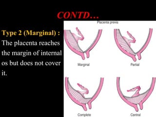 Placenta previa | PPT