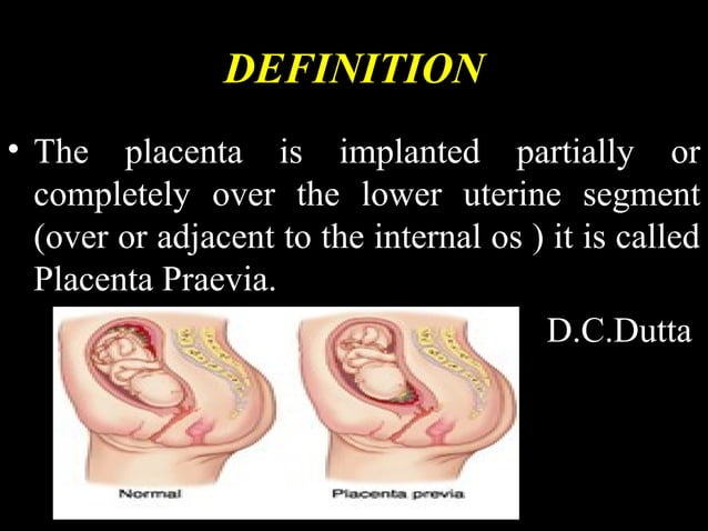 Placenta previa | PPT