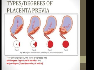 Placenta Accreta Diagram