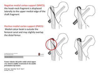 Tips, tricks and pitfalls of proximal femoral nailing (PFN) | PPTX