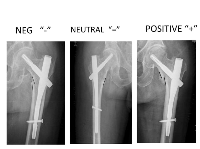 Tips, tricks and pitfalls of proximal femoral nailing (PFN) | PPTX