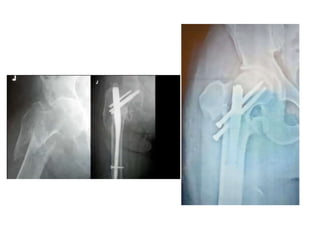 Tips, tricks and pitfalls of proximal femoral nailing (PFN) | PPTX