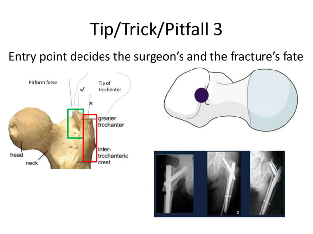 Tips, tricks and pitfalls of proximal femoral nailing (PFN) | PPTX