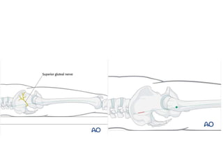 Tips, tricks and pitfalls of proximal femoral nailing (PFN) | PPTX
