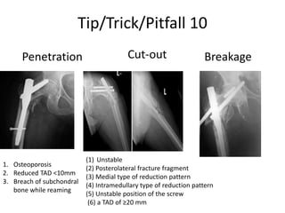 Tips, tricks and pitfalls of proximal femoral nailing (PFN) | PPT