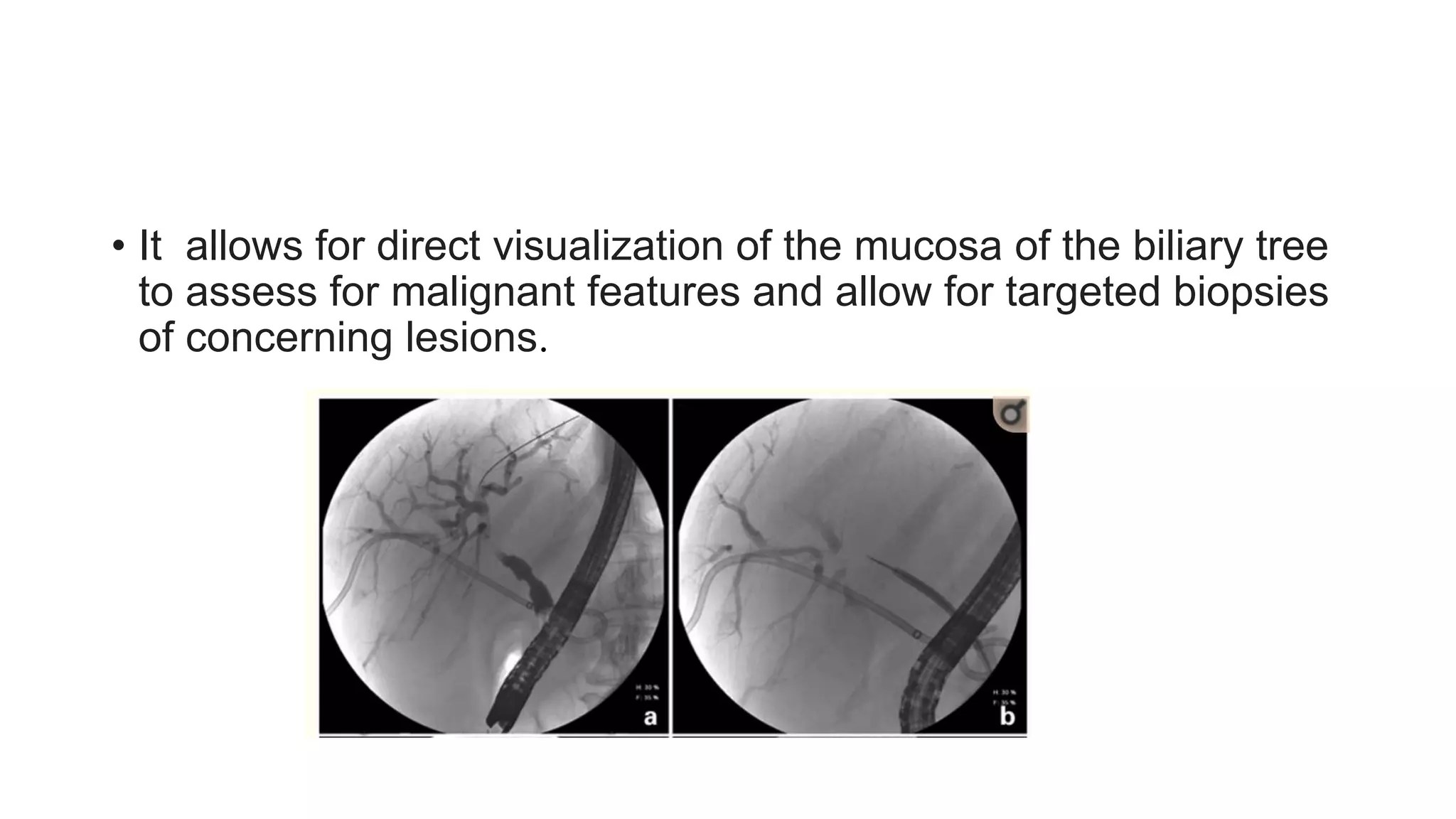 Management of Benign Biliary Stricture | PPTX