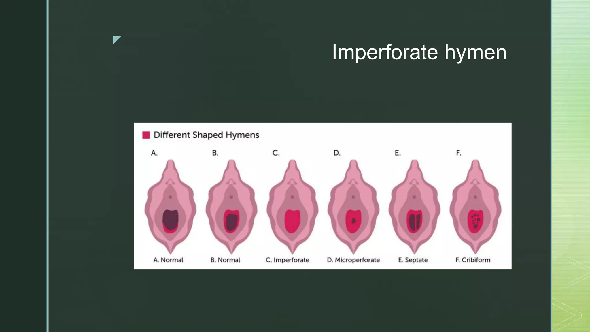 Female infertility and its causes | PPTX