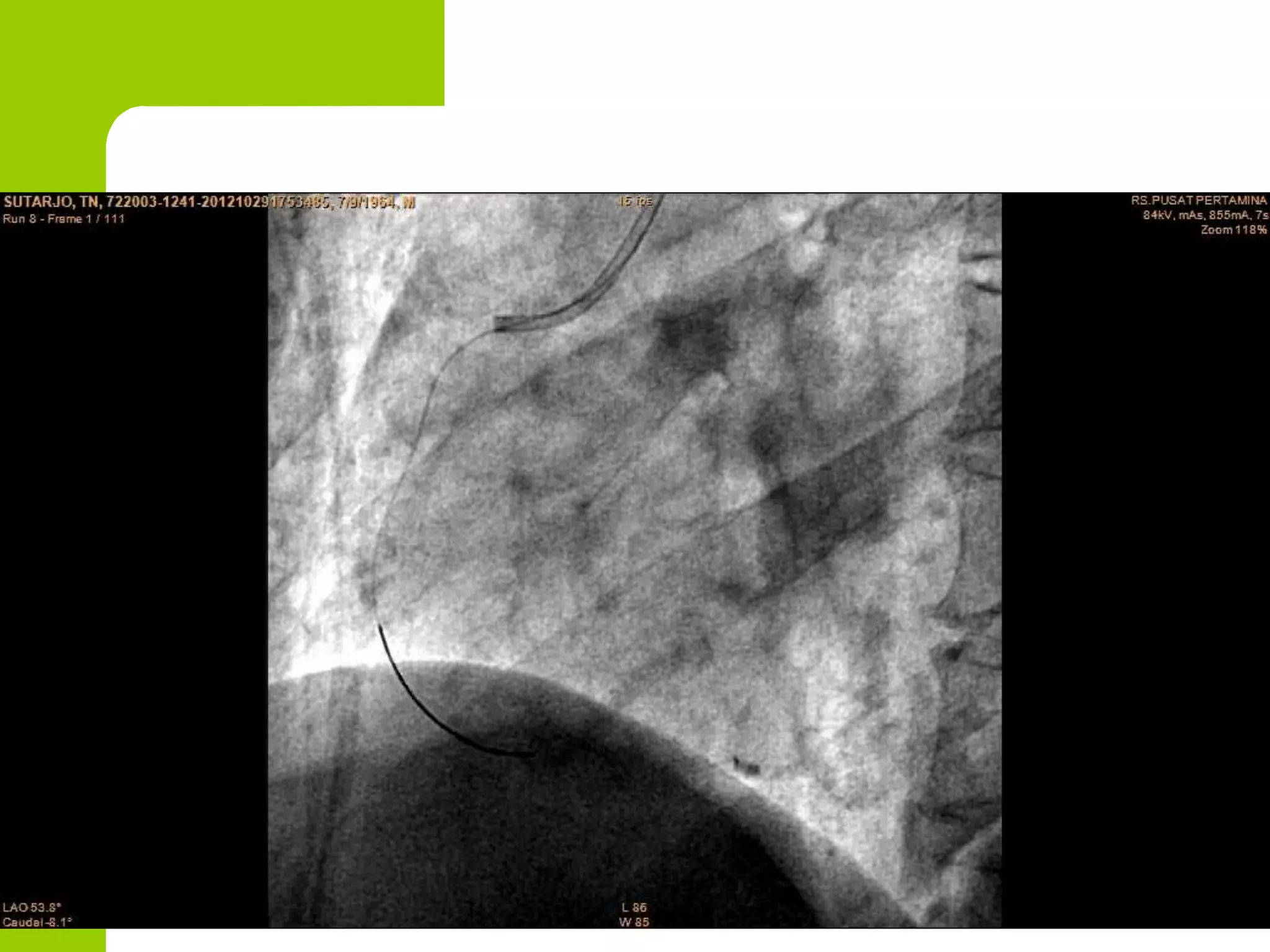 PPT. PTCA CATHLAB.ppt