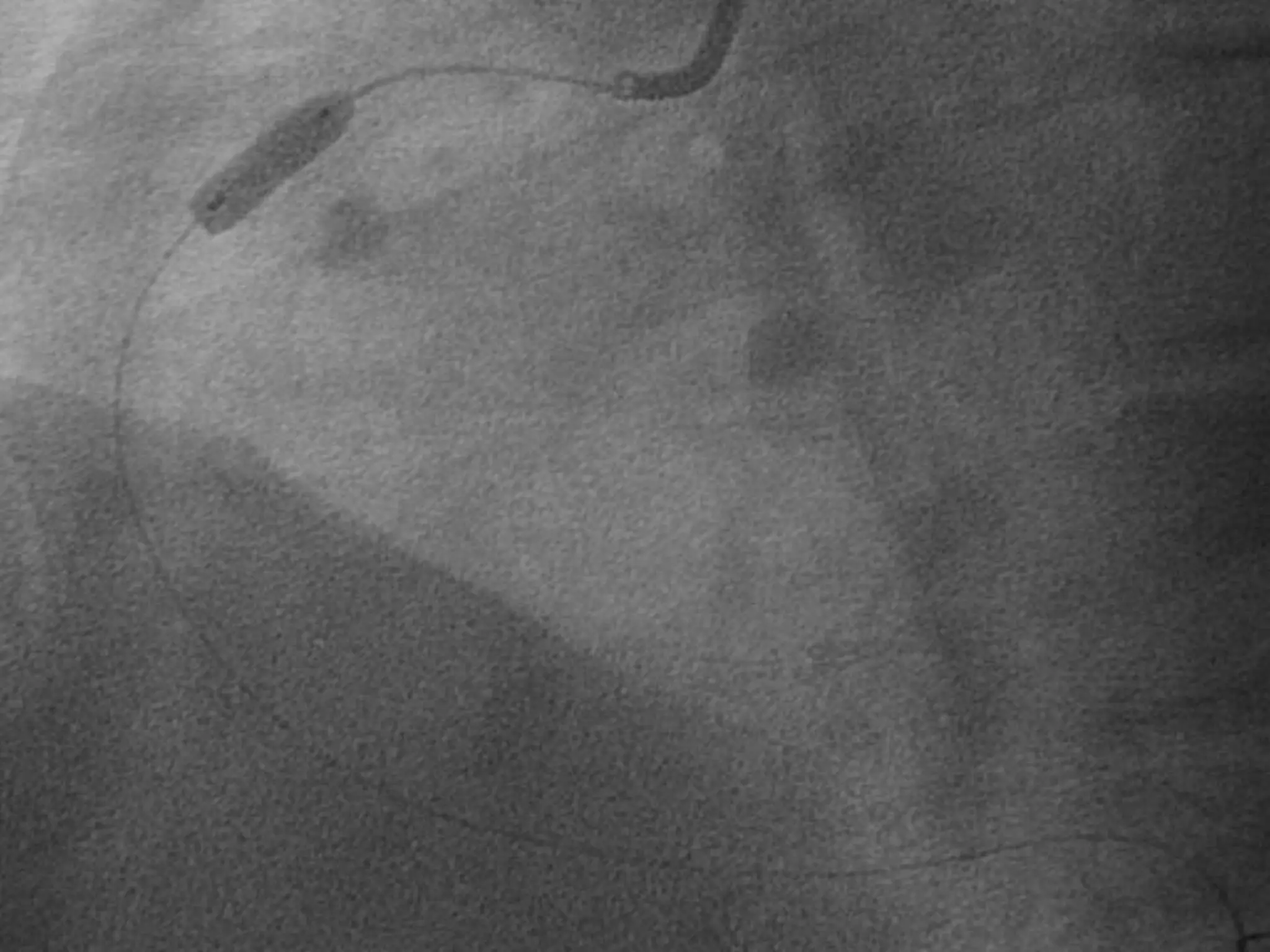 PPT. PTCA CATHLAB.ppt