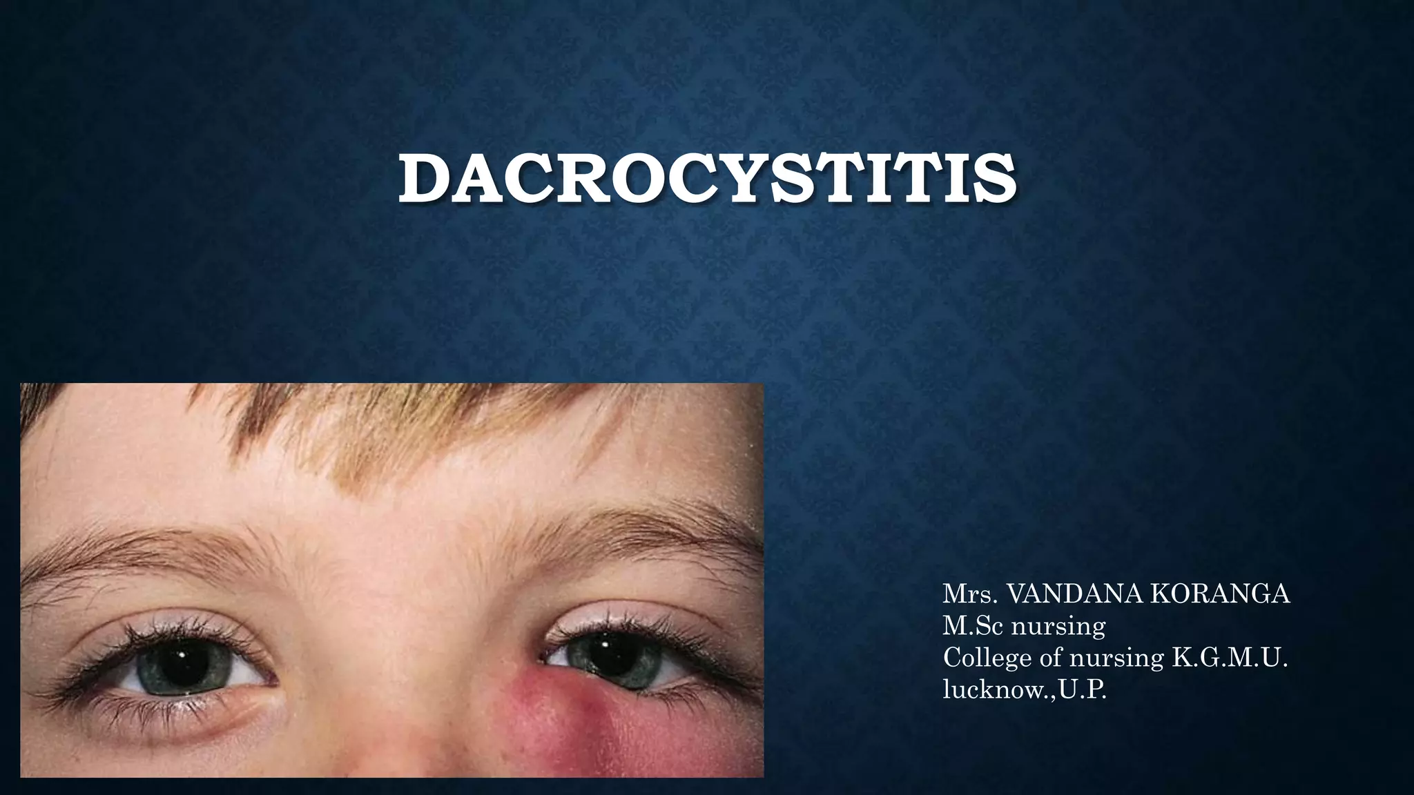 ppt.DACROCYSTITIS.pptx