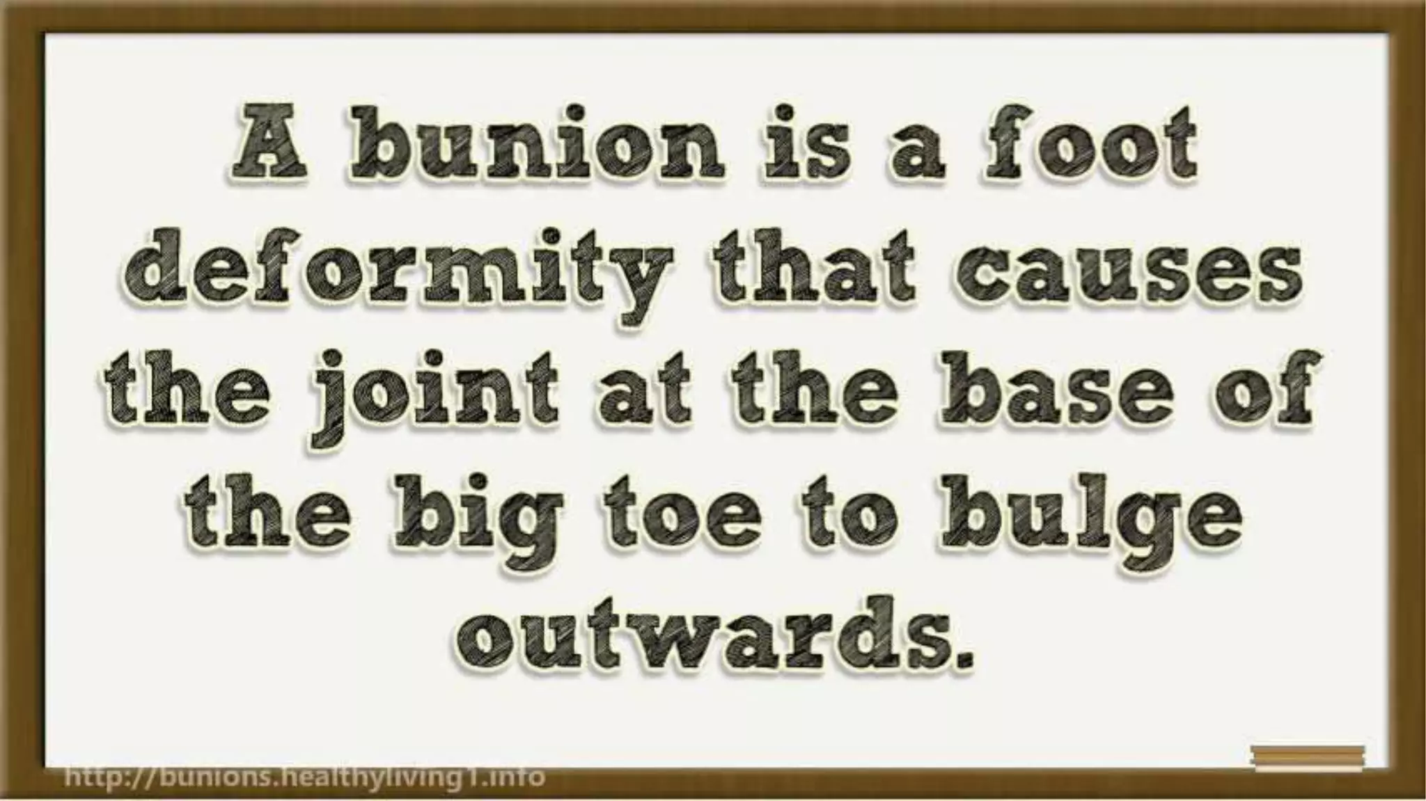 Bunions: Causes, Prevention and Bunion Treatment | PPT