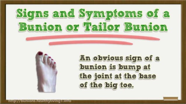 Bunions: Causes, Prevention and Bunion Treatment | PPT