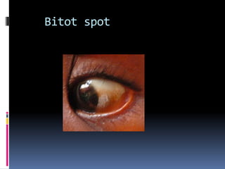 PPT - CHILDHOOD ILLNESSES.pptx