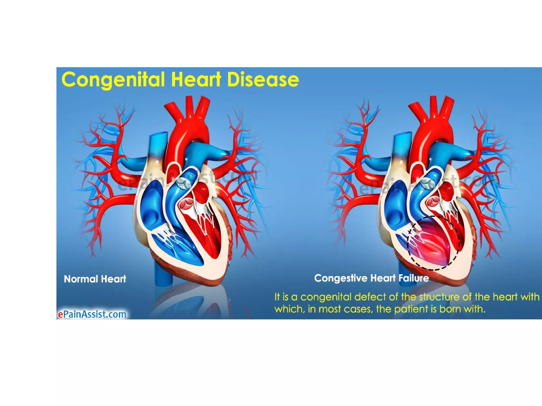 congenital heart defect in children | PPT