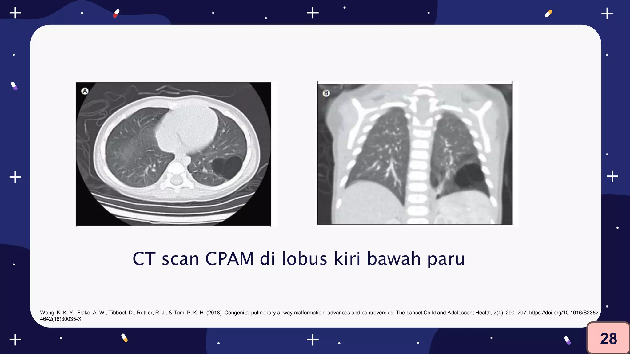 Congenital Pulmonary Airway Malformation REV.pptx