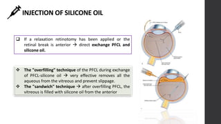 Manajemen Komplikasi Silicone Oil Post Vitrektomi | PPTX | Eye and ...