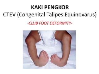 Congenital Talipes Equinovarus (CETV), Kaki Pengkor | PPTX
