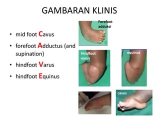 Congenital Talipes Equinovarus (CETV), Kaki Pengkor | PPTX