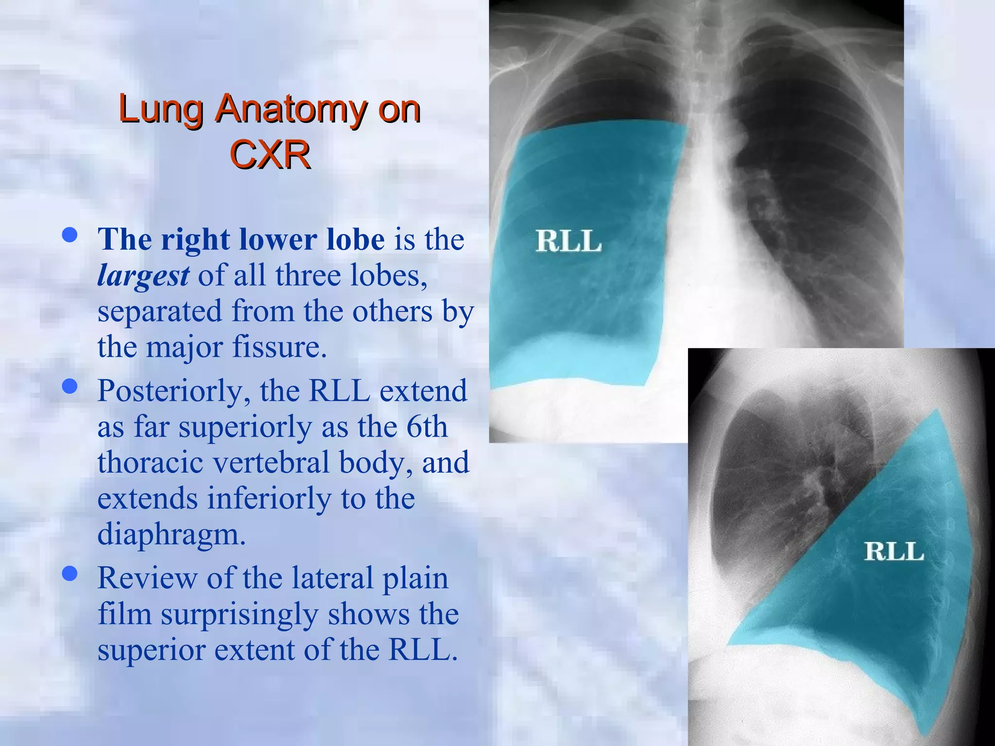 HOW TO READ CXR | PPT
