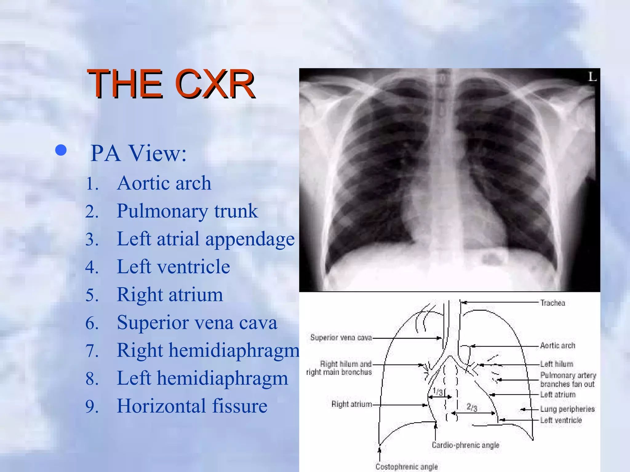 HOW TO READ CXR | PPT