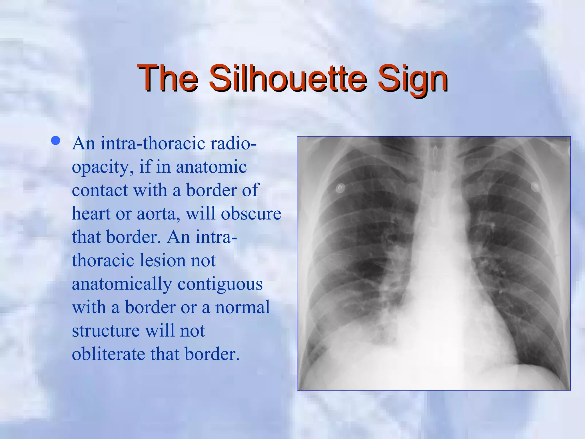 HOW TO READ CXR | PPT