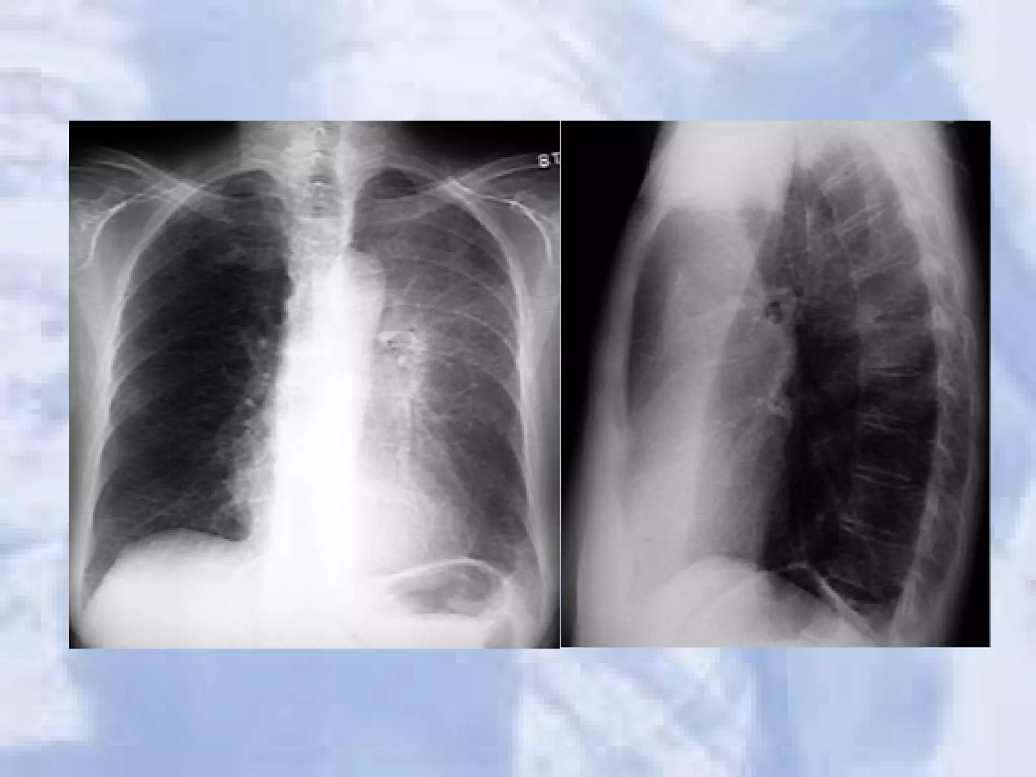 HOW TO READ CXR | PPT