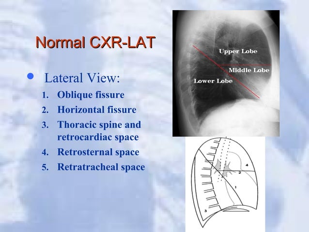 HOW TO READ CXR | PPT