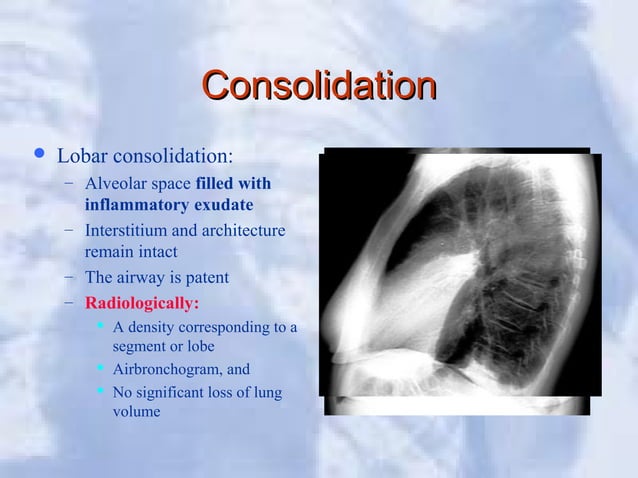 HOW TO READ CXR | PPT