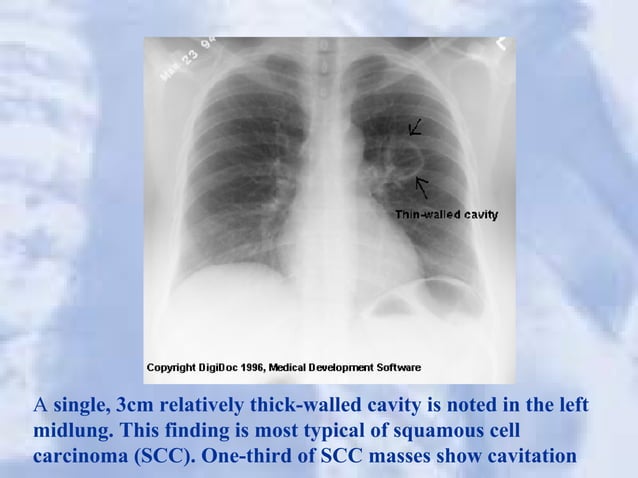 HOW TO READ CXR | PPT