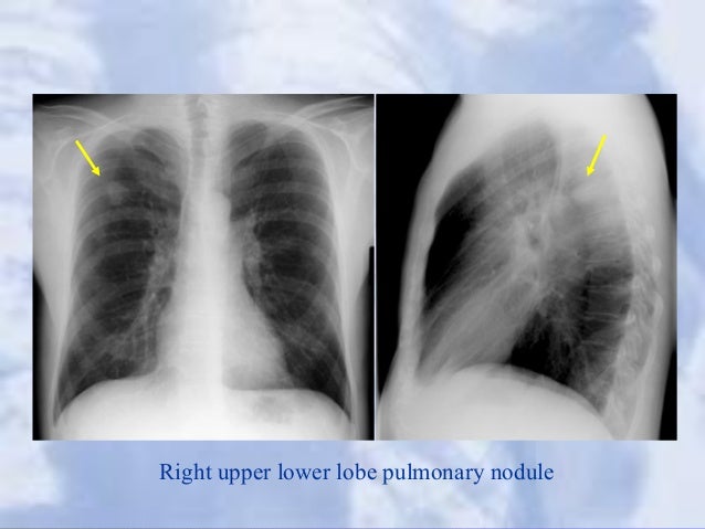 Reading Cxr Lateral