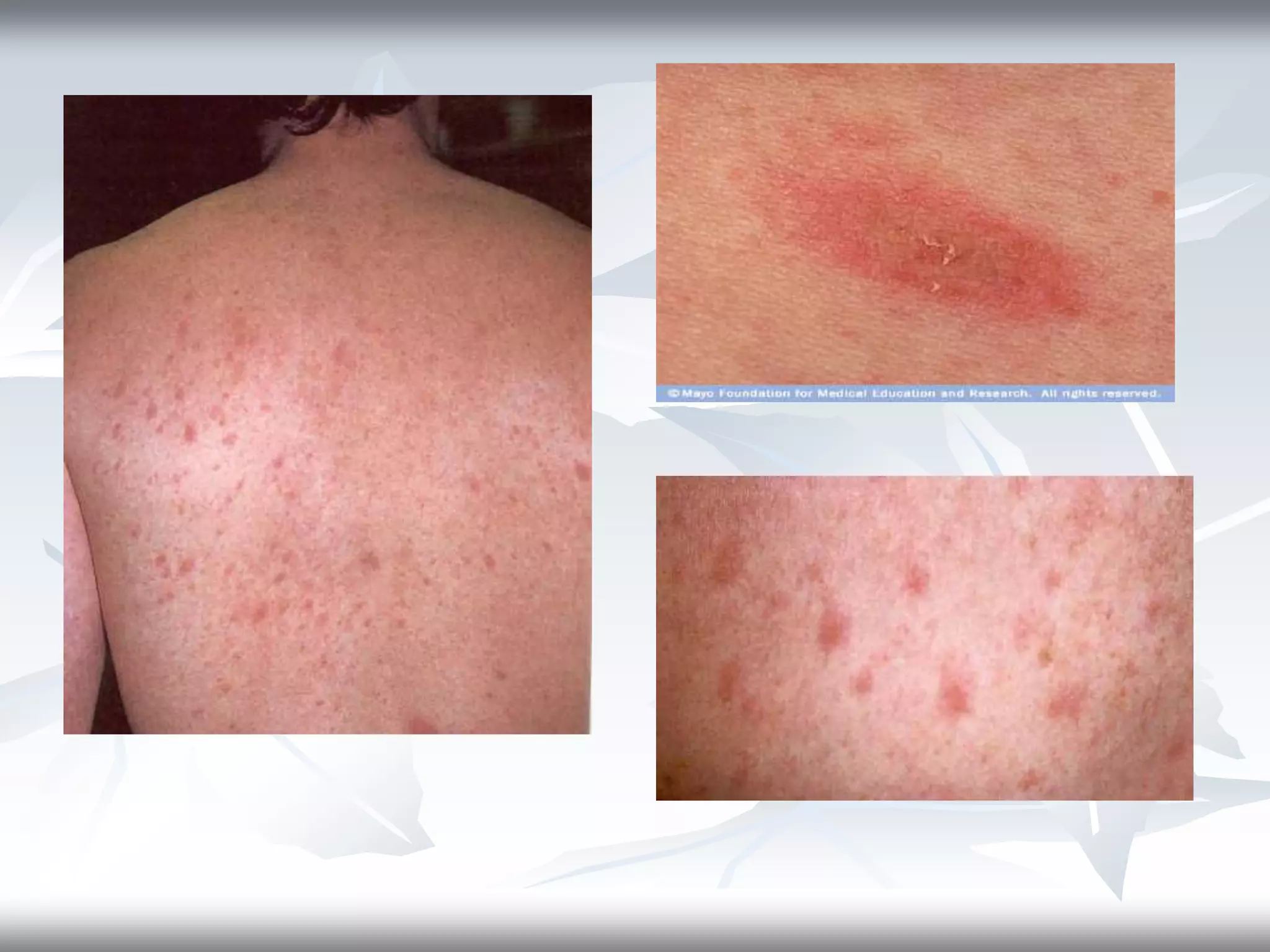 ppt-dev-ptiriasis-rosea (1).ppt