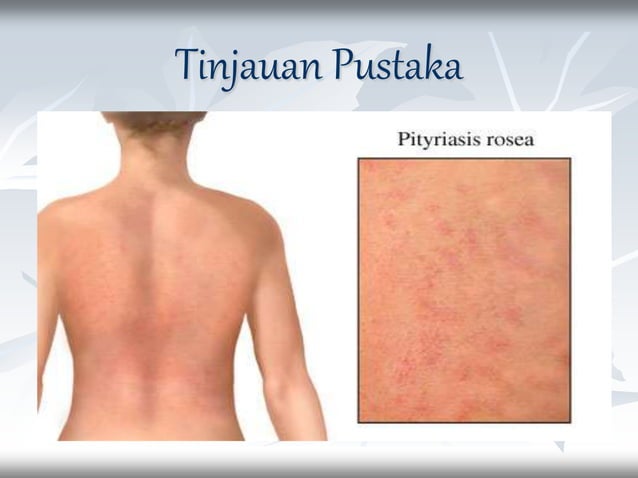 ppt-dev-ptiriasis-rosea (1).ppt