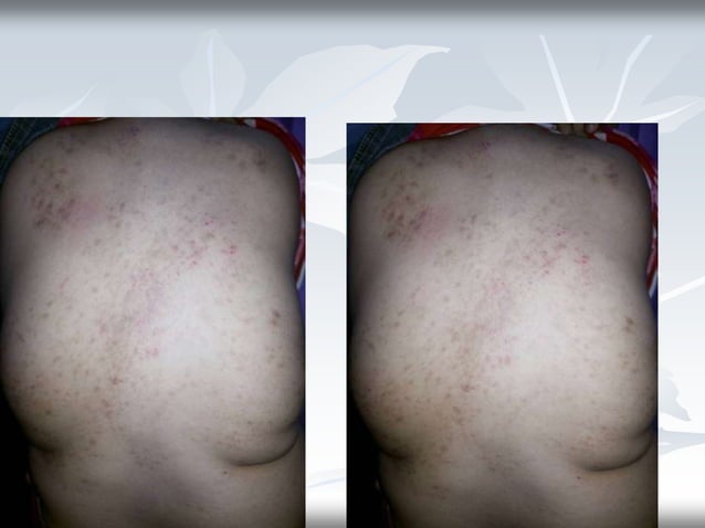 ppt-dev-ptiriasis-rosea (1).ppt