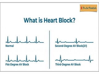 PPT-HEART-BLOCK.pptx cardiovascular disorder | PPTX