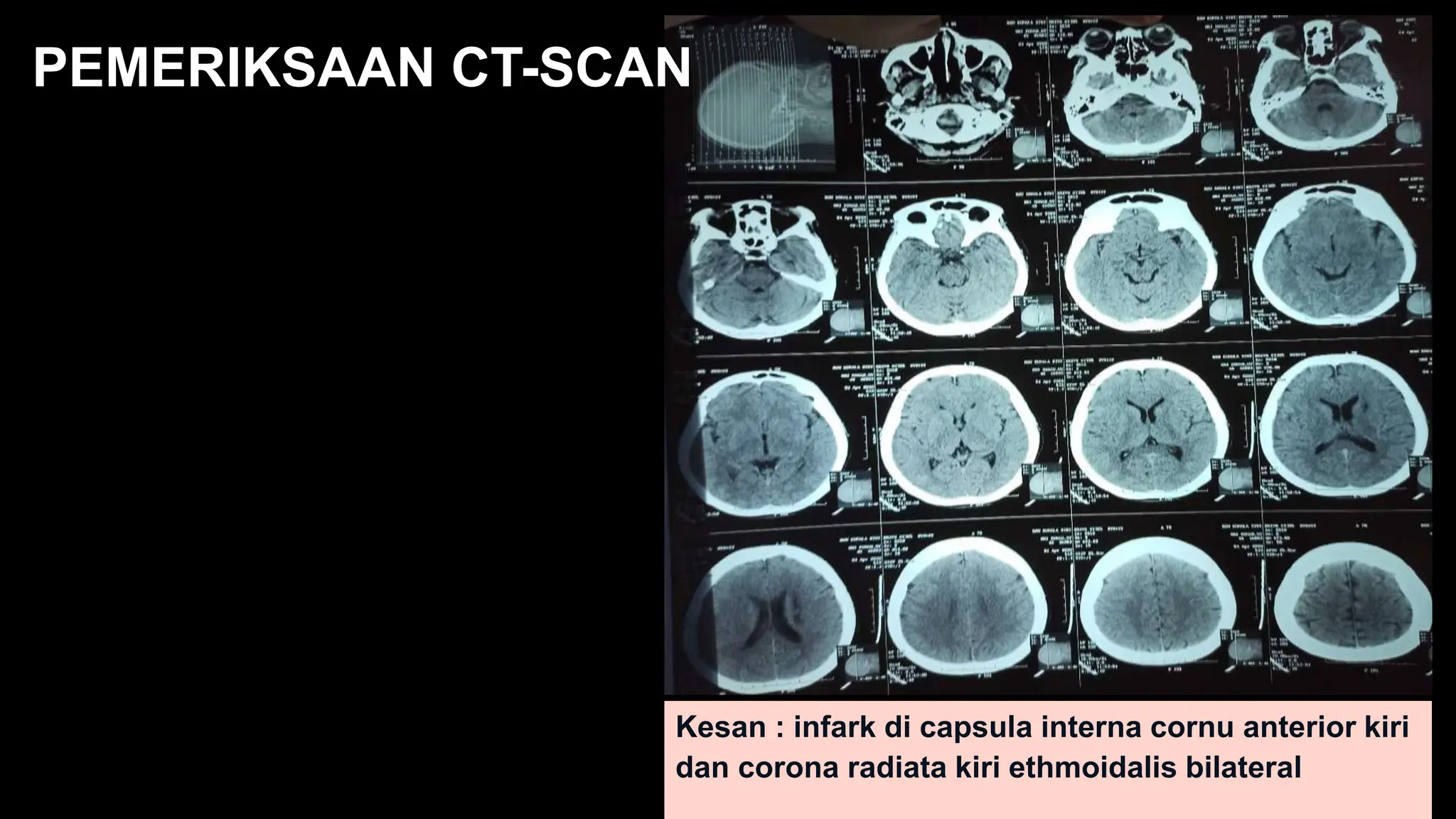 ppt -kasus snh- dr Radityo-hospital.pptx