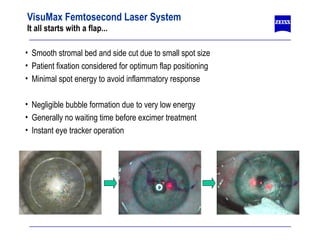 VisuMax Femtosecond Laser System The triangle of treatment parameters | PPT
