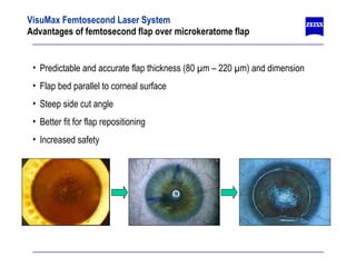 VisuMax Femtosecond Laser System The triangle of treatment parameters | PPT