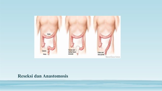 Ppt-Referat-Bedah-CA-Recti.pptx untuk belajar | PPT