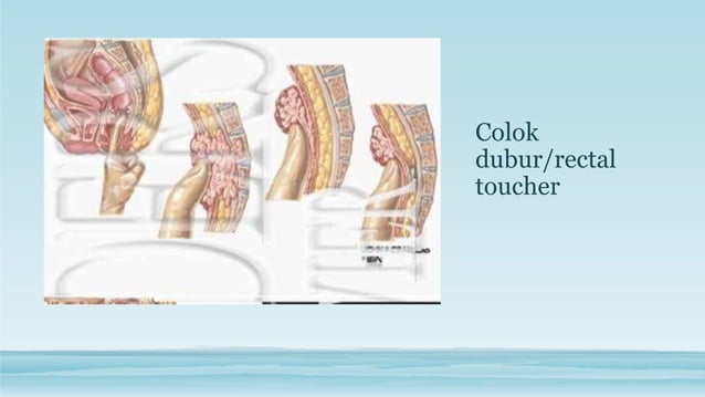 Ppt-Referat-Bedah-CA-Recti.pptx untuk belajar | PPT