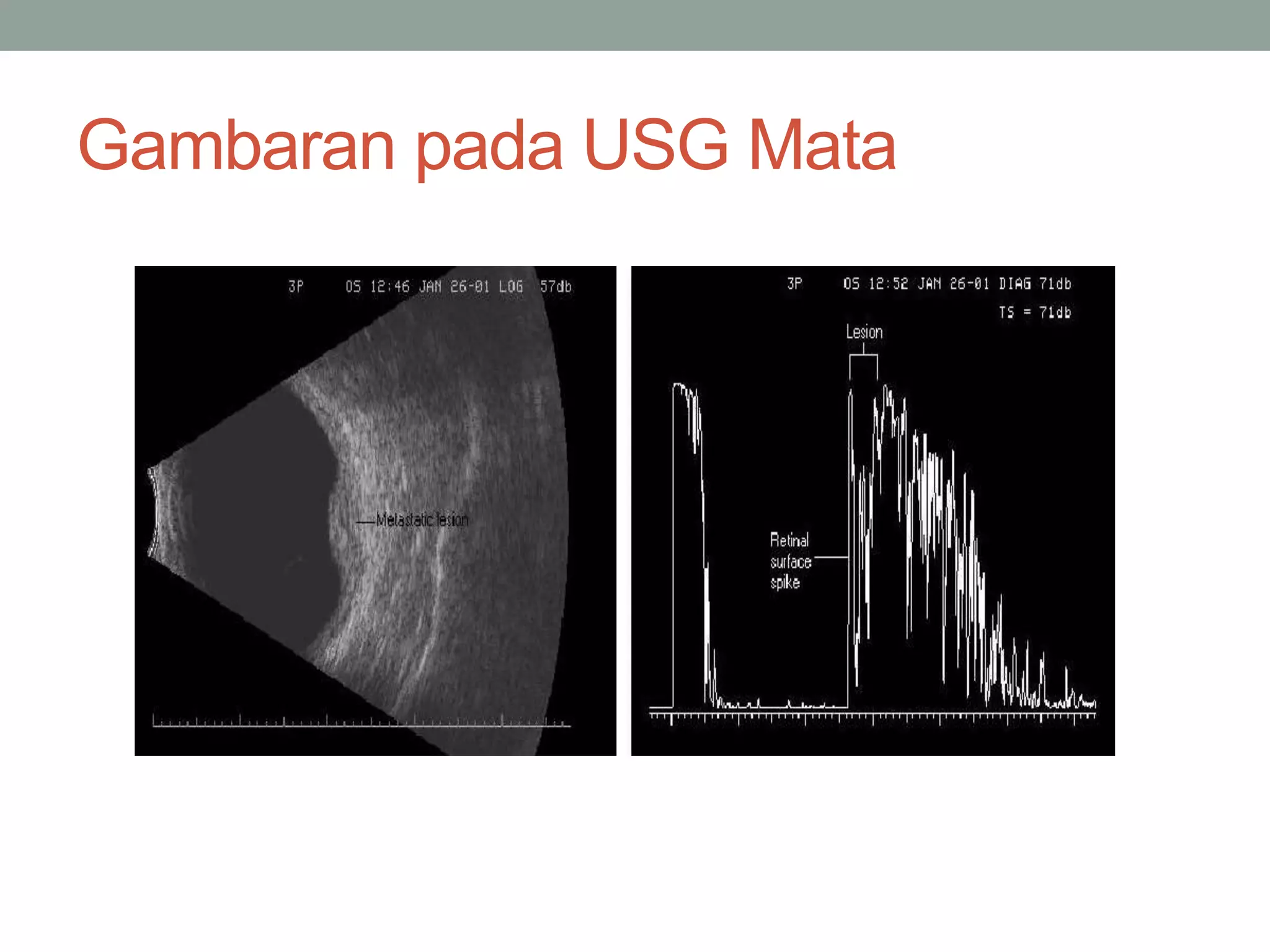 ppt-referat-usg-mata.pptx