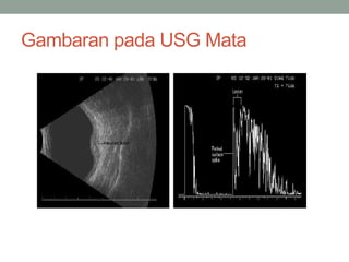 ppt-referat-usg-mata.pptx